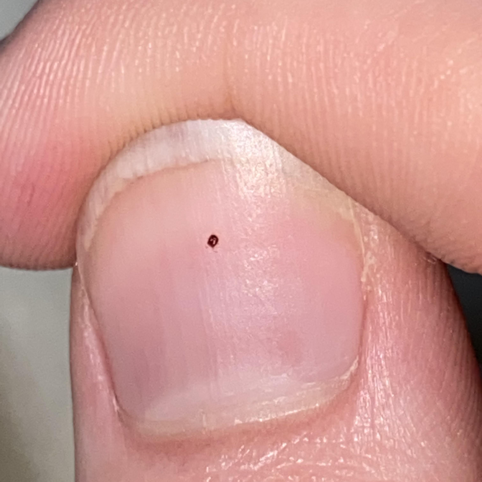 Comment savoir si j'ai des poux rouges